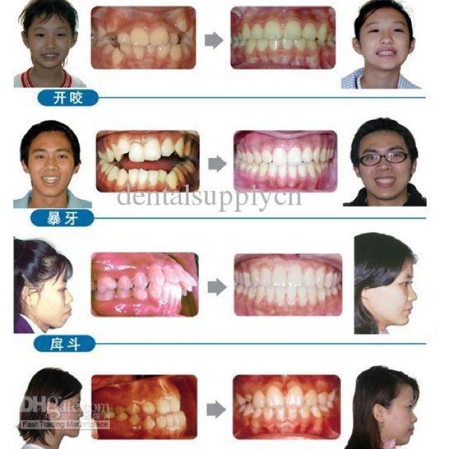 INSTOCK Teeth Alignment Kit, Beauty & Personal Care, Face, Face Care on ...