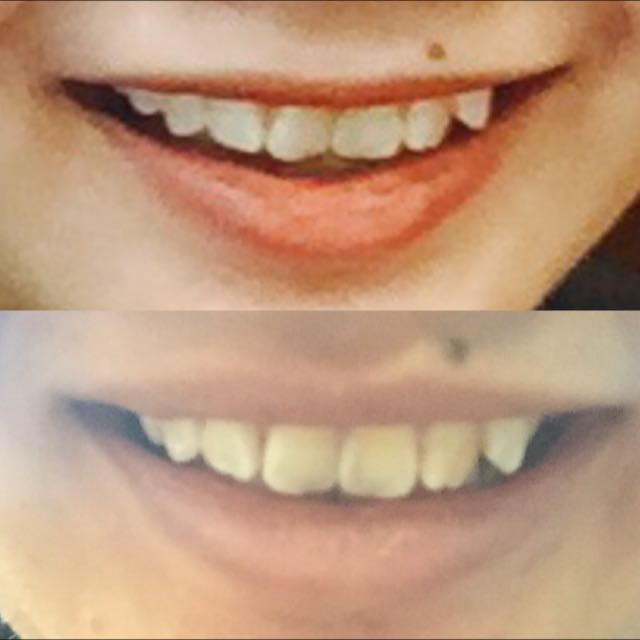 INSTOCK Teeth Alignment Kit, Beauty & Personal Care, Face, Face Care on ...