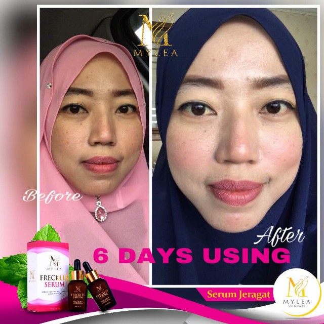 Mylea freckles serum, Health & Nutrition, Health Supplements, Vitamins & Supplements on Carousell