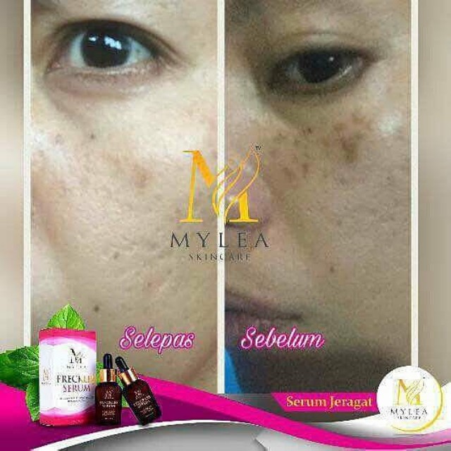 Mylea freckles serum, Health & Nutrition, Health Supplements, Vitamins & Supplements on Carousell