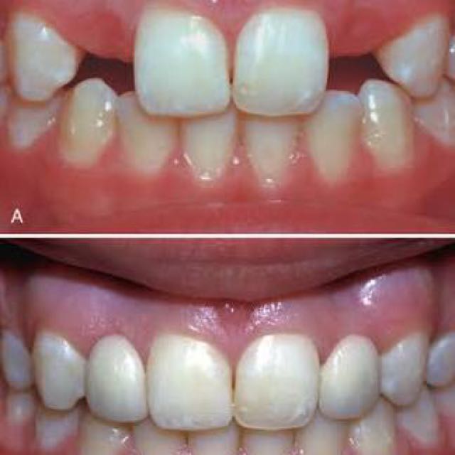 Free fixed partial denture, Beauty & Personal Care, Face, Face Care on ...