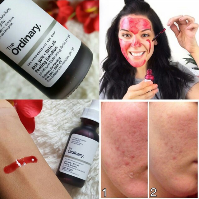 The Ordinary - AHA 30% + BHA 2% Peeling Solution, Beauty & Personal ...
