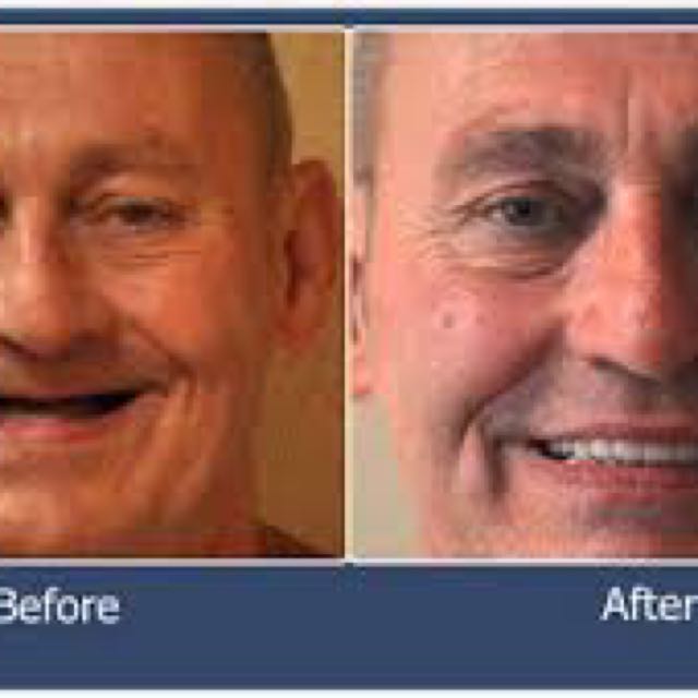 Pustiso. Free denture, Everything Else, Others on Carousell