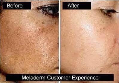 MELADERM for Hyperpigmentation, Beauty & Personal Care, Face, Face Care ...