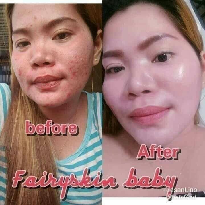 FAIRY SKIN DERMA SET, Beauty & Personal Care, Face, Face Care on Carousell