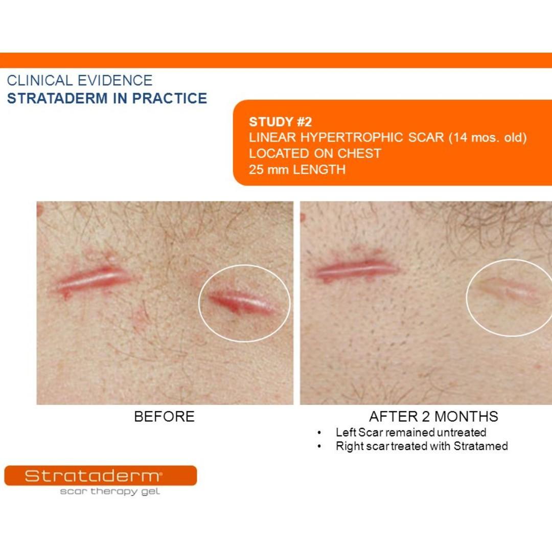Strataderm Scar Therapy Gel 10g, Beauty & Personal Care, Face, Face ...