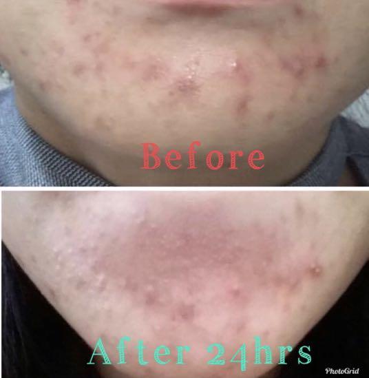 Acne clear solution, Beauty & Personal Care, Face, Face Care on Carousell