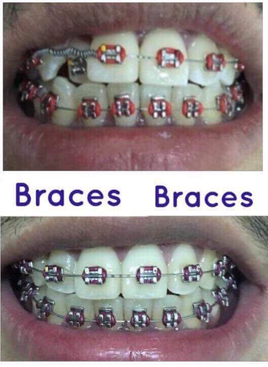 Dental Braces and Fixed Bridges, Beauty & Personal Care, Oral Care on ...