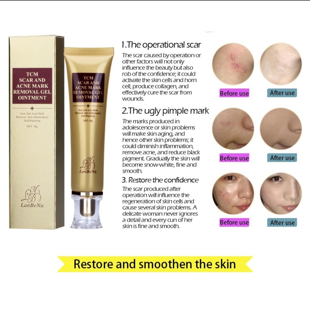 TCM Scar and Acne Mark Removal Gen Ointment inc postage, Beauty ...