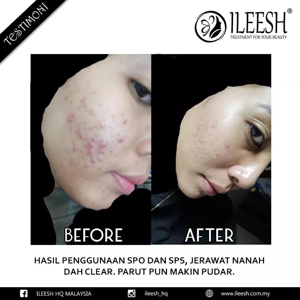 SPO Skin Potion Oil Serum by Ileesh, Beauty & Personal Care, Face, Face ...