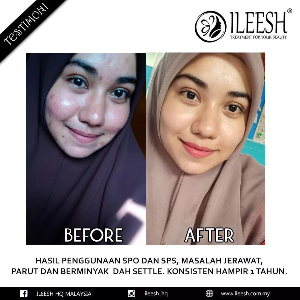 SPO Skin Potion Oil Serum by Ileesh, Beauty & Personal Care, Face, Face ...