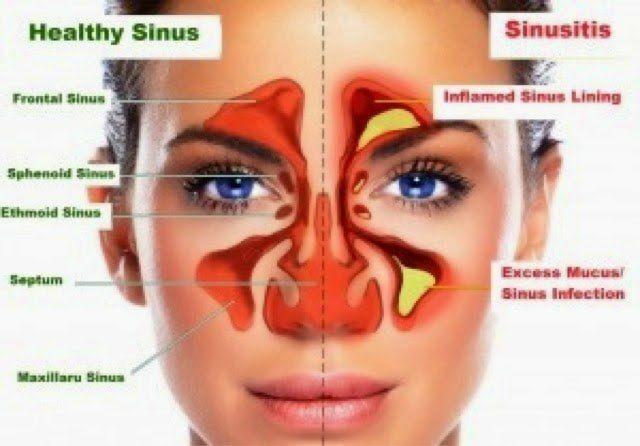 Jamu Sinus Clear Penawar Resdung, Everything Else on Carousell