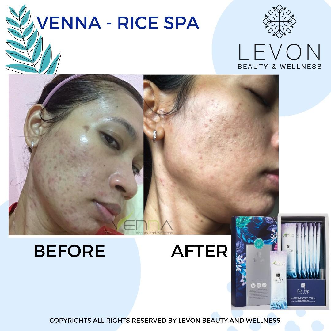 Rice Spa - Mask, Beauty & Personal Care, Face, Face Care on Carousell