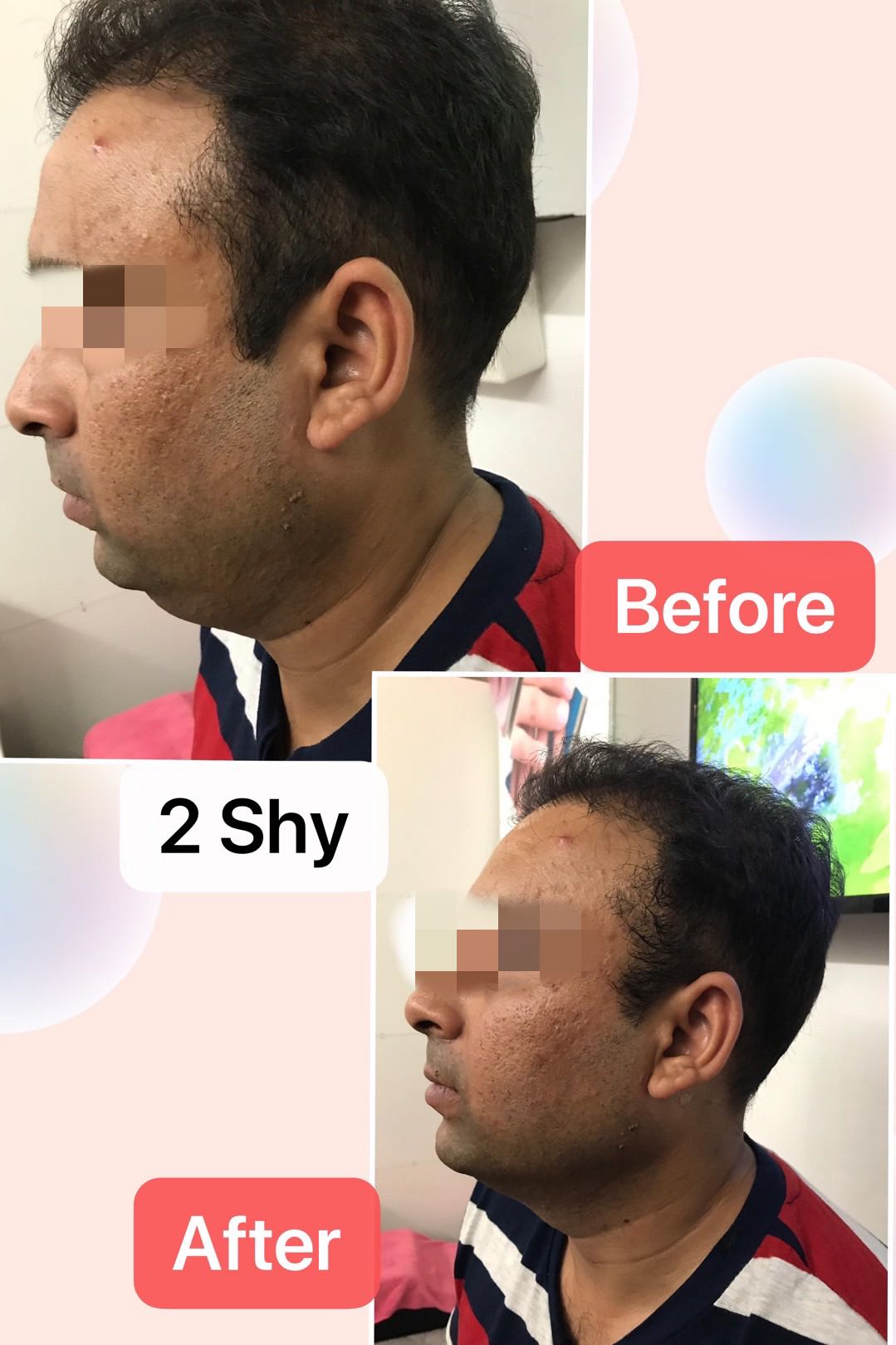 AUG Promo: Medical grade Double Chin Treatment (FDA approved) can ...