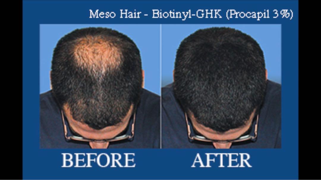 MESO HAIR Intensive Hair Therapy ampoules ampoules serum tonic ... MESO HAIR Intensive Hair Therapy ampoules ampoules serum tonic ...