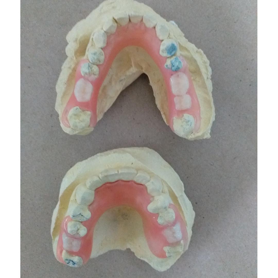 Flexible Denture Pustiso Fixed Bridge E-max Zirconia Jacket Crown ...