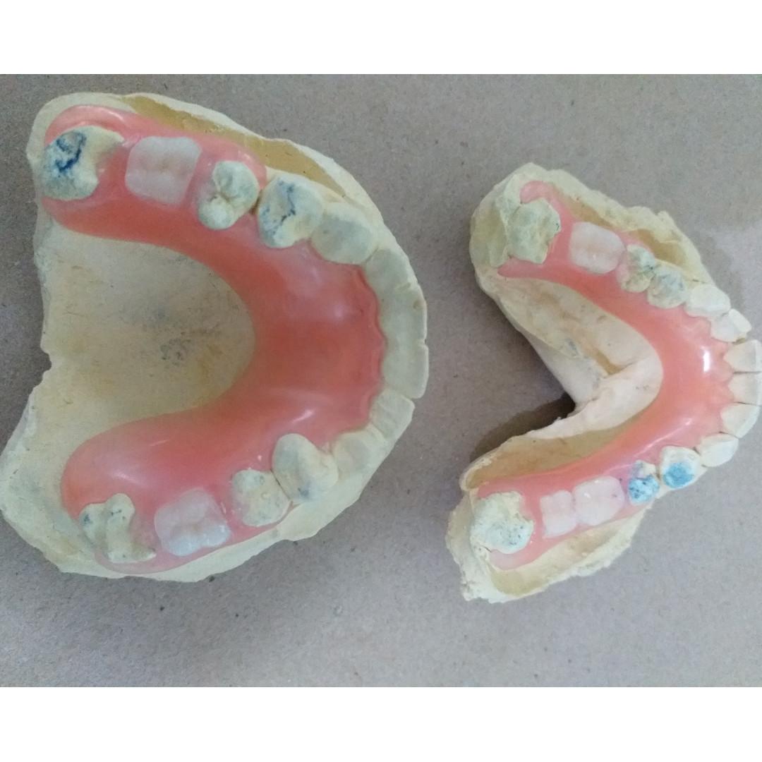 Flexible Denture Pustiso Fixed Bridge E-max Zirconia Jacket Crown ...