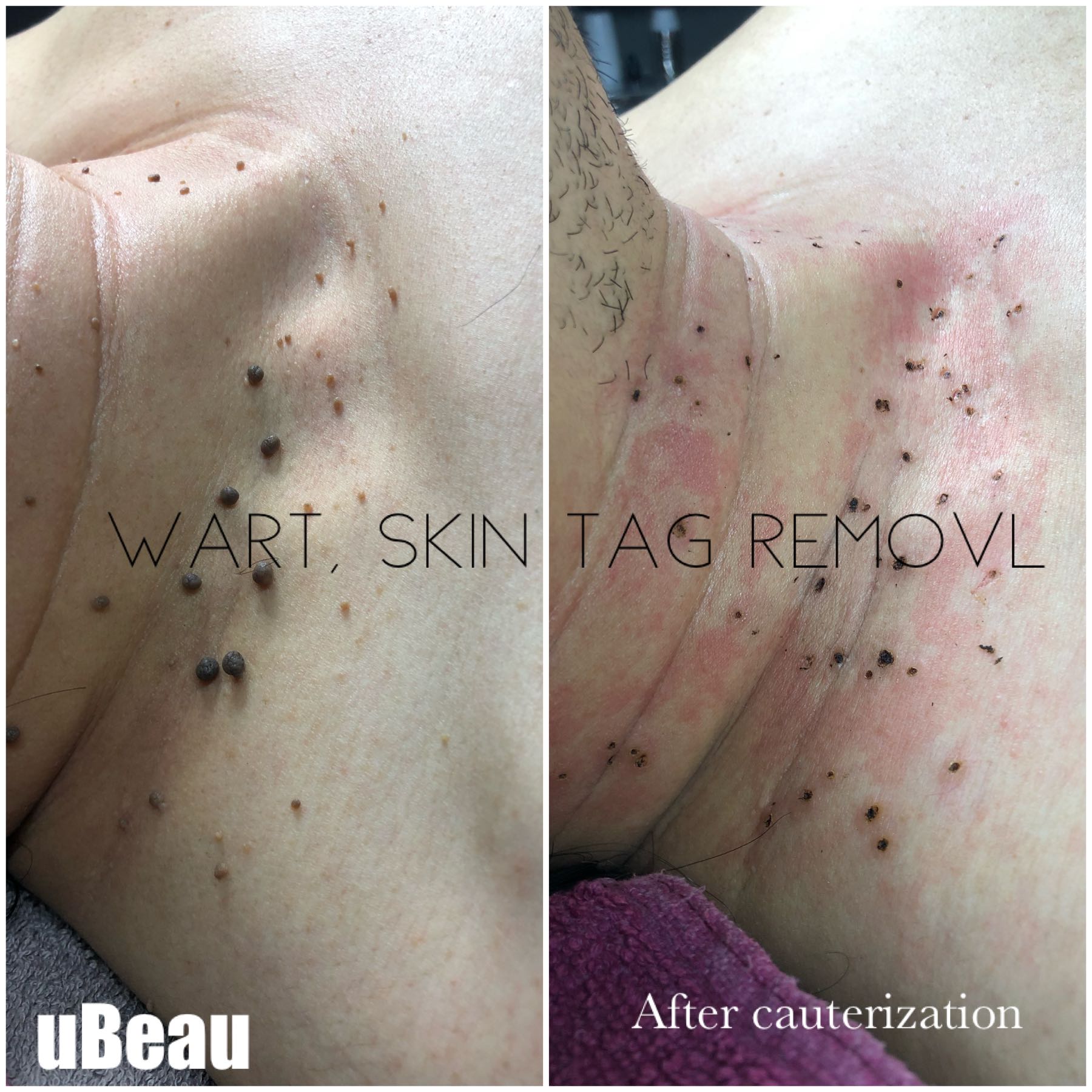 Mole wart skin tag removal, Beauty & Personal Care, Face, Face Care ...