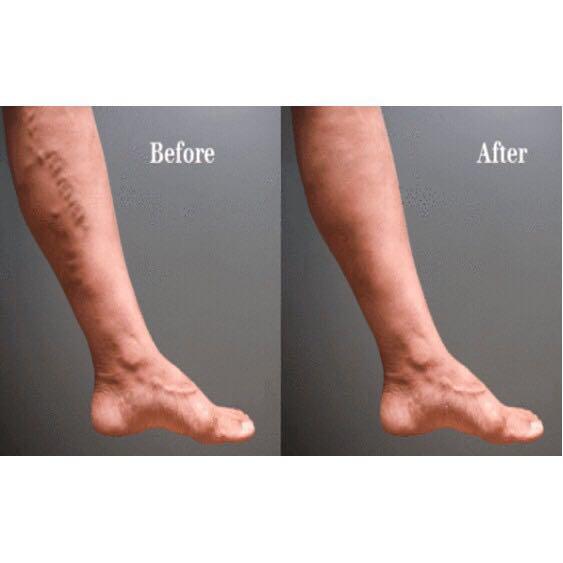 Salep anti varises keloid luka bakar cut burns obat, Kesehatan ...