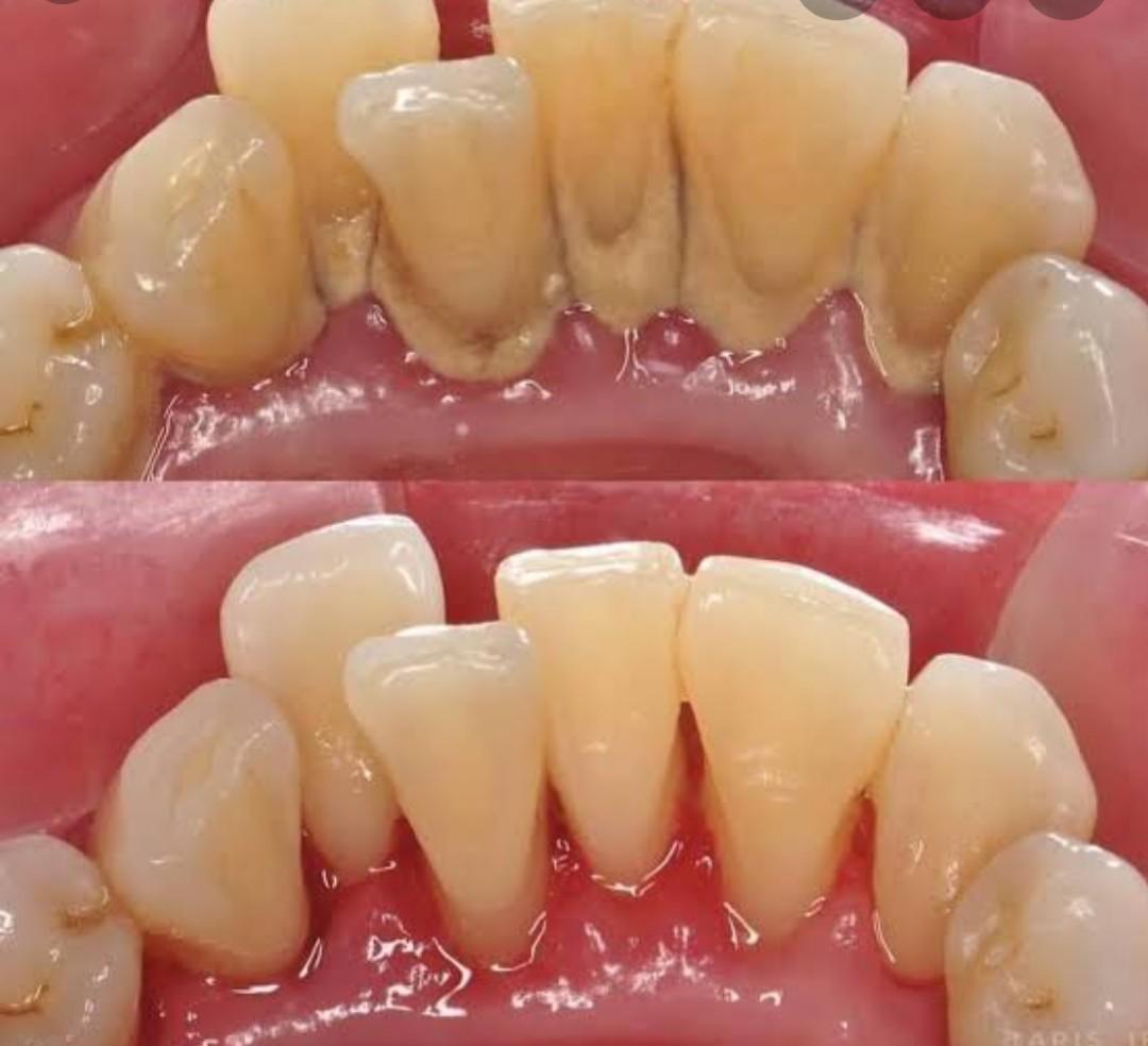 Teeth restoration, extraction, jacket crown, scaling cleaning, brackets ...