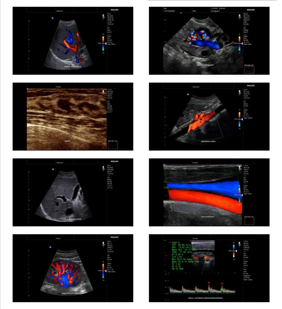 Philips innosight ultrasound machine, Health & Nutrition, Health ...