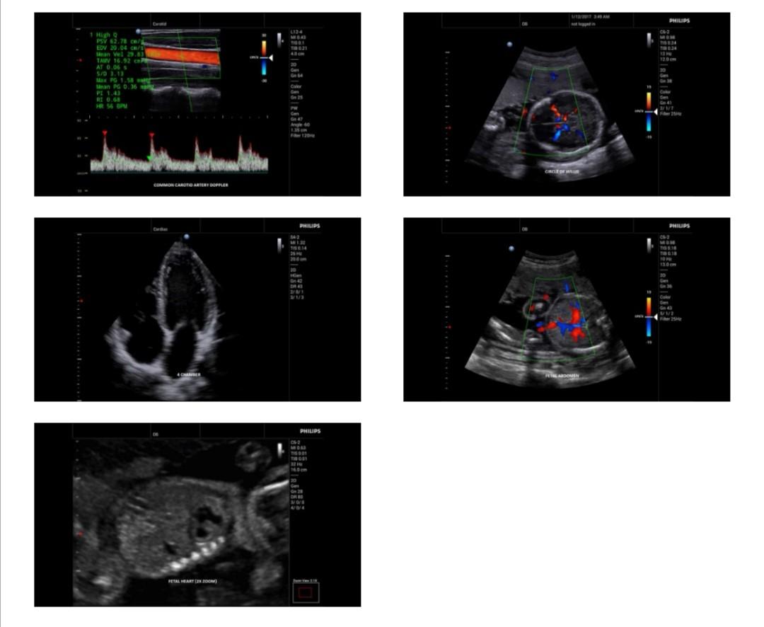 Philips innosight ultrasound machine, Health & Nutrition, Health ...