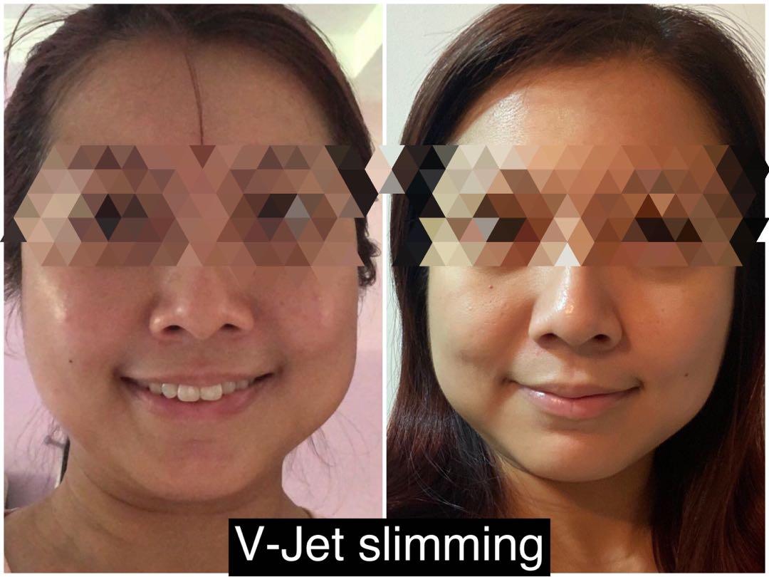 V-Jet fat melting Double Chin ,face slimming , Body slimming FOC full ...
