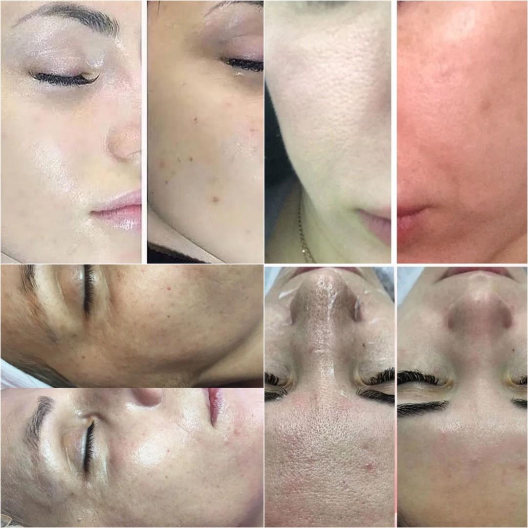 2Way Nano meso white skin rejuvenation whiten brightens clear acne ...