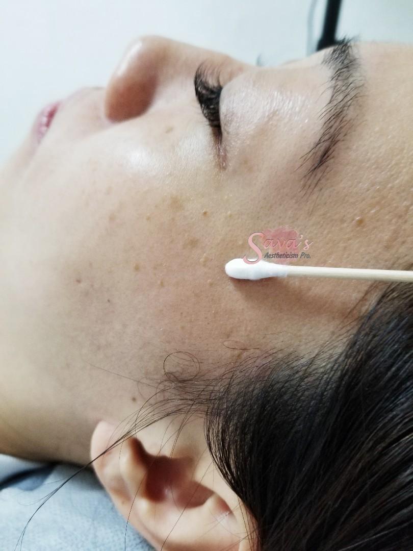 脫疣$500 包 100粒 眼面頸, 美容＆個人護理, 健康及美容 - 皮膚護理, 面部 - 面部護理 - Carousell