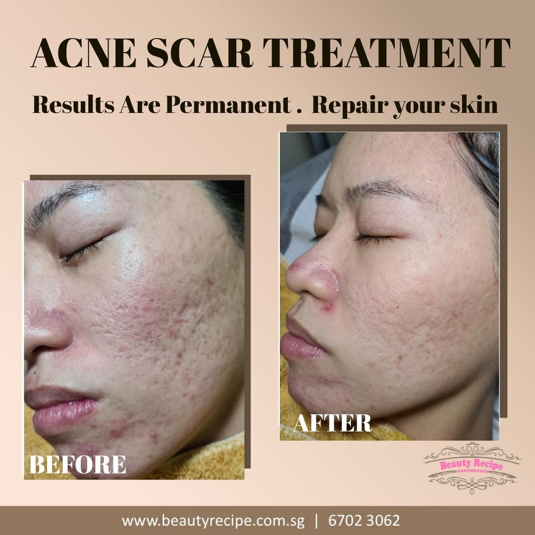 Acne Scars or Surgical Scar Removal By Plasma Fibroblast Treatment ...
