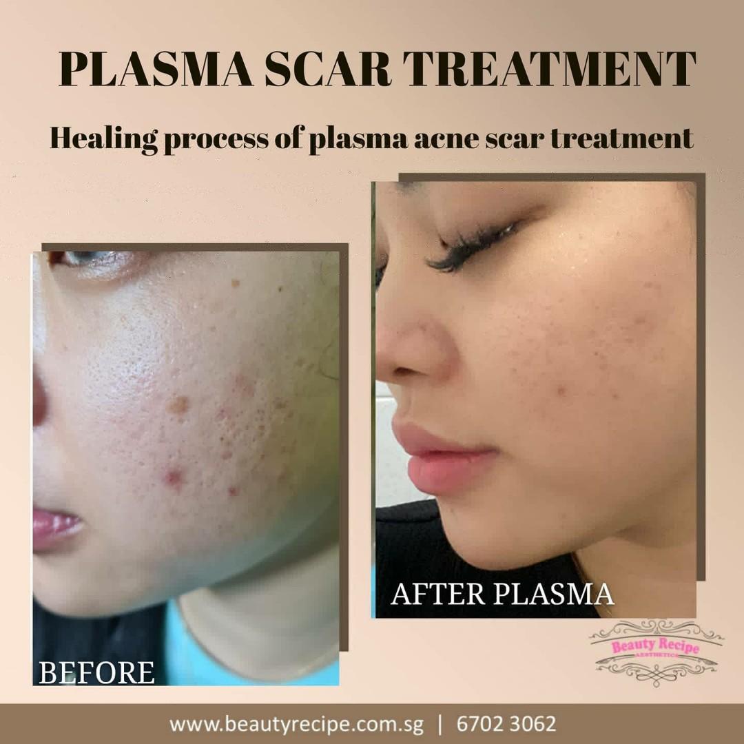 Acne Scars or Surgical Scar Removal By Plasma Fibroblast Treatment ...