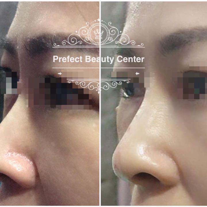 Nose Bridge, Nose Tips, Lips, Chin, Temple, Forehead, Under Eye ...