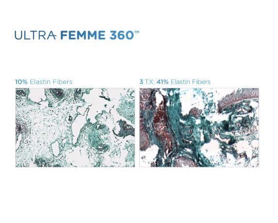 AUTHENTIC BTL Ultra Femme 360 CHECK AUTHENTICITY https://btlaesthetics ...