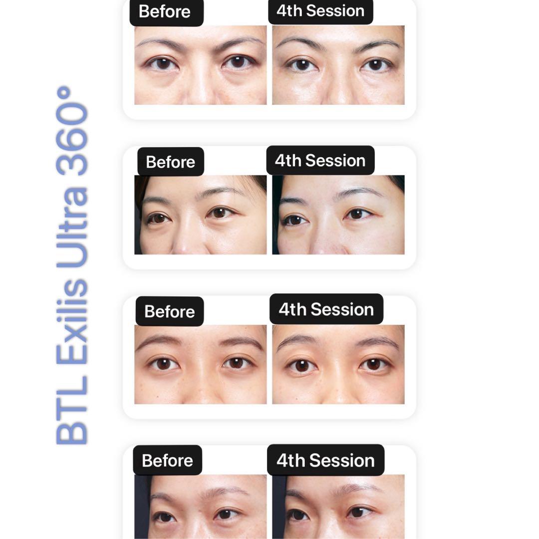 Authentic Medical Grade BTL Exilis Ultra 360° Eyebag / Dark Circle ...