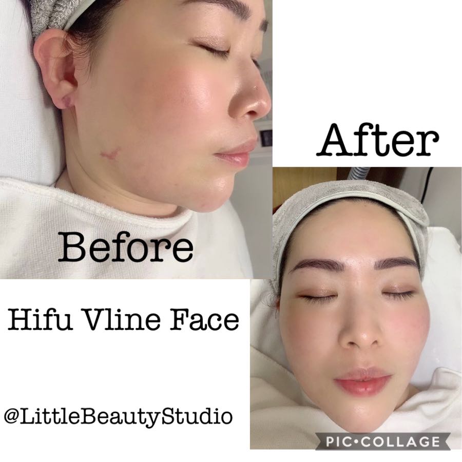 Vline face without injection, Lifestyle Services, Beauty & Health ...