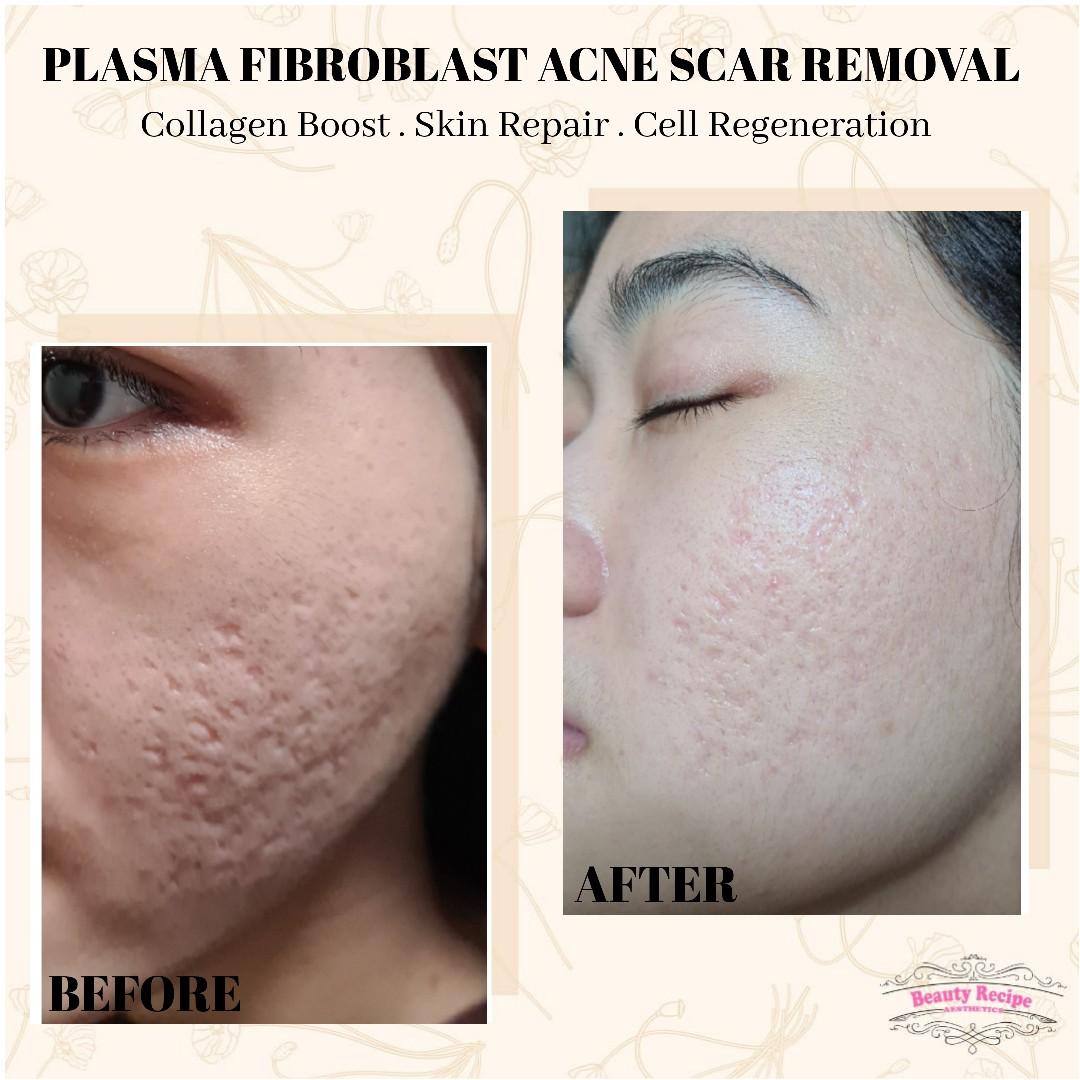 Acne Scars or Surgical Scar Removal By Plasma Fibroblast Treatment ...