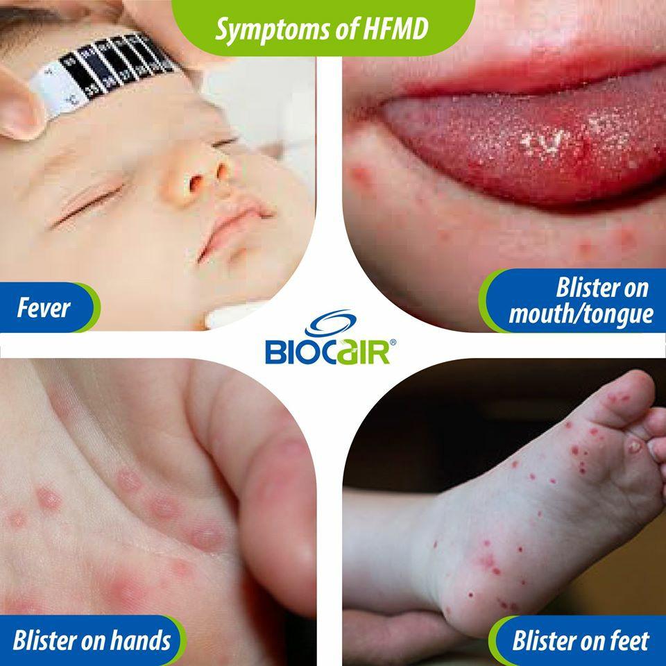 Biocair for HFMD, Babies & Kids, Bathing & Changing, Diapers & Baby ...
