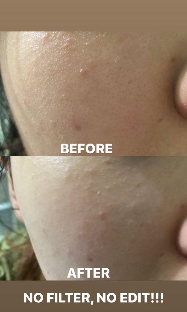 SAMANLI BUBBLE MASK , Beauty & Personal Care, Face, Face Care on Carousell