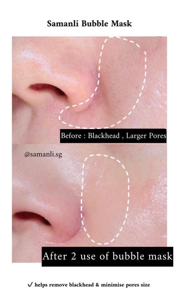SAMANLI Bubble mask, Beauty & Personal Care, Face, Face Care on Carousell