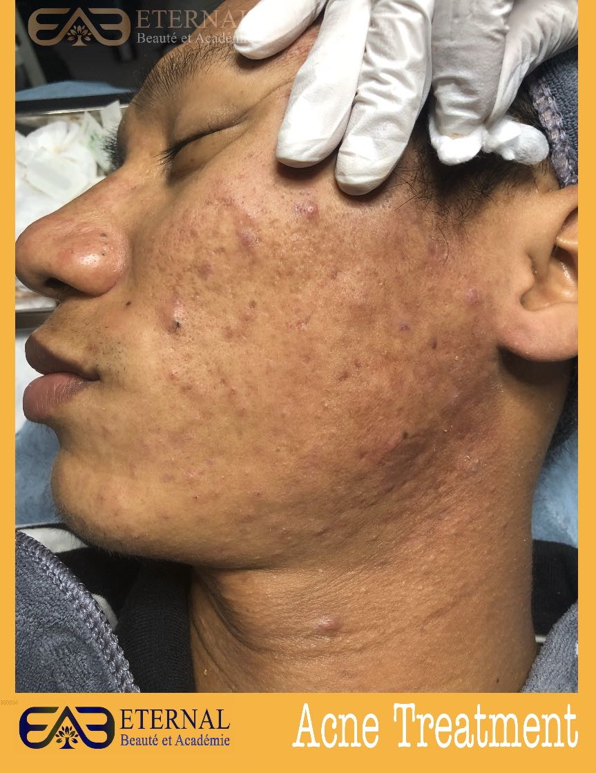 Pimple extraction , Beauty & Personal Care, Face, Face Care on Carousell