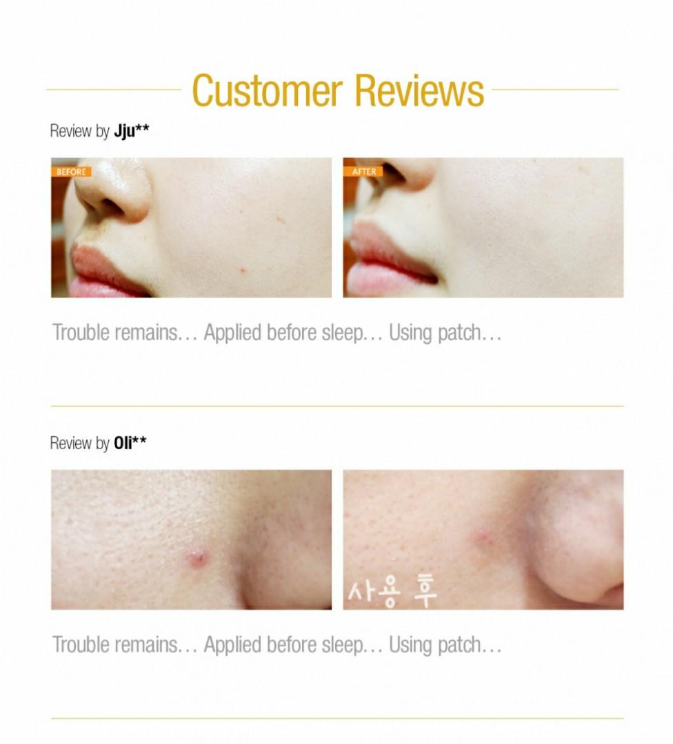 Acropass Spot Eraser Micro Needle Patch, Beauty & Personal Care, Face ...