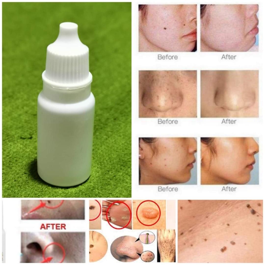 Liquid mole skin tag wart removal, Beauty & Personal Care, Face, Face ...