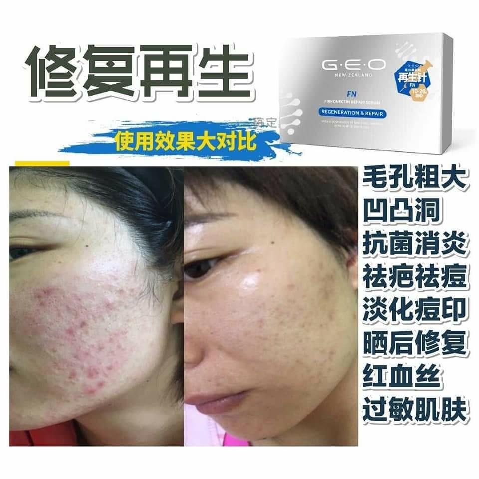Hm Treament Before and after photo (Geoskincare), Beauty & Personal ...