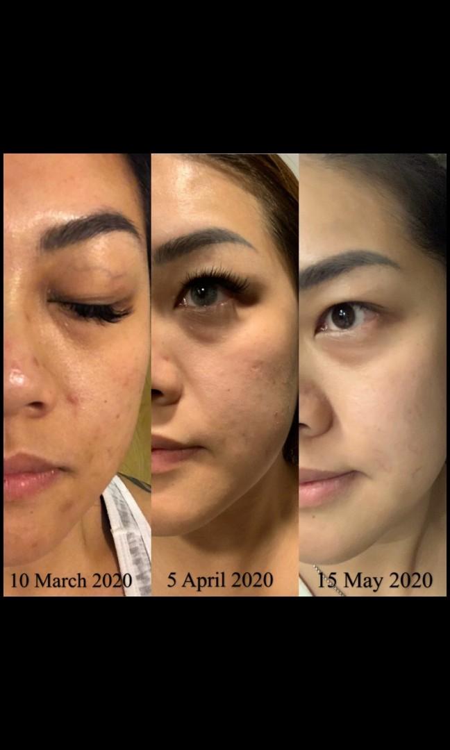 Hm Treament Before and after photo (Geoskincare), Beauty & Personal ...