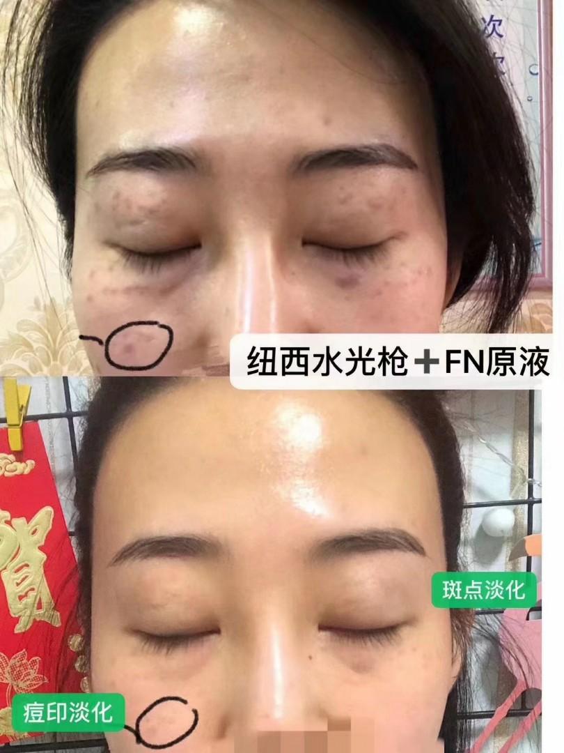 Hm Treament Before and after photo (Geoskincare), Beauty & Personal ...