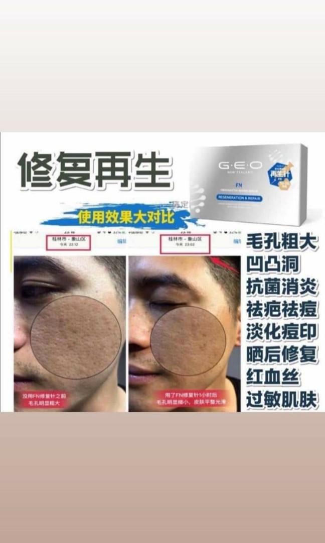 Hm Treament Before and after photo (Geoskincare), Beauty & Personal ...