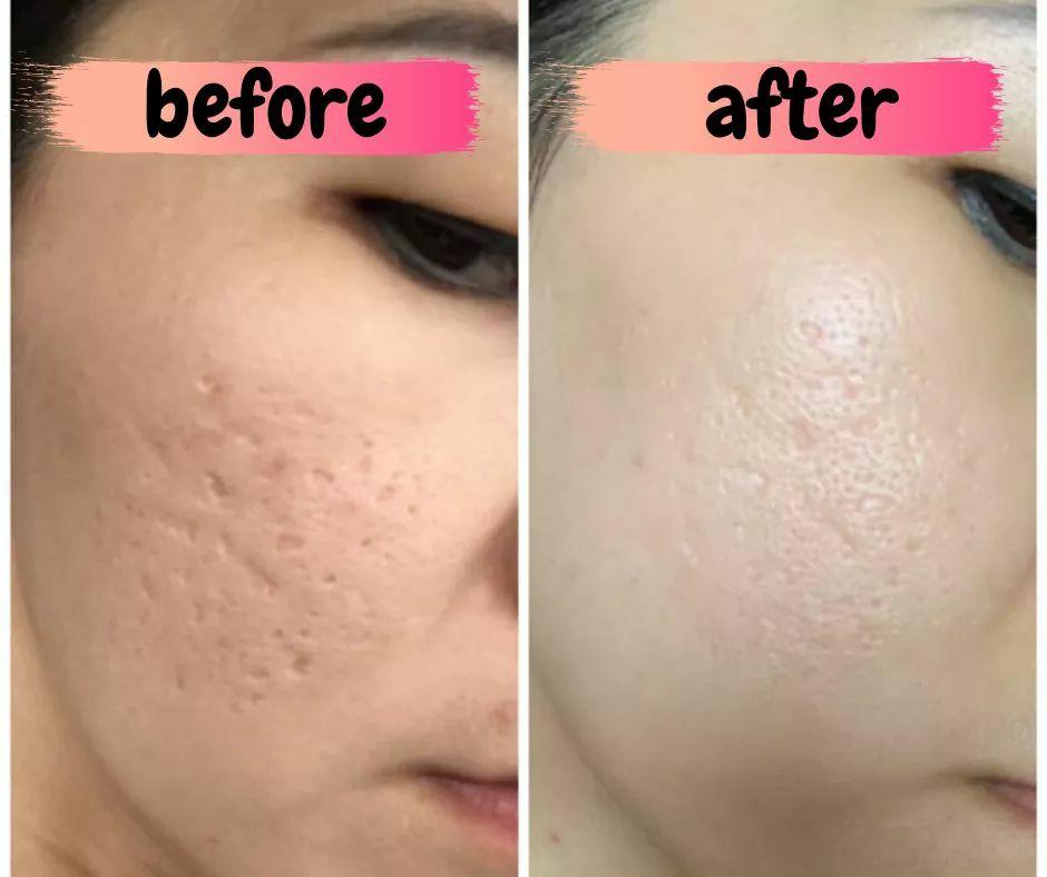 Hm Treament Before and after photo (Geoskincare), Beauty & Personal ...