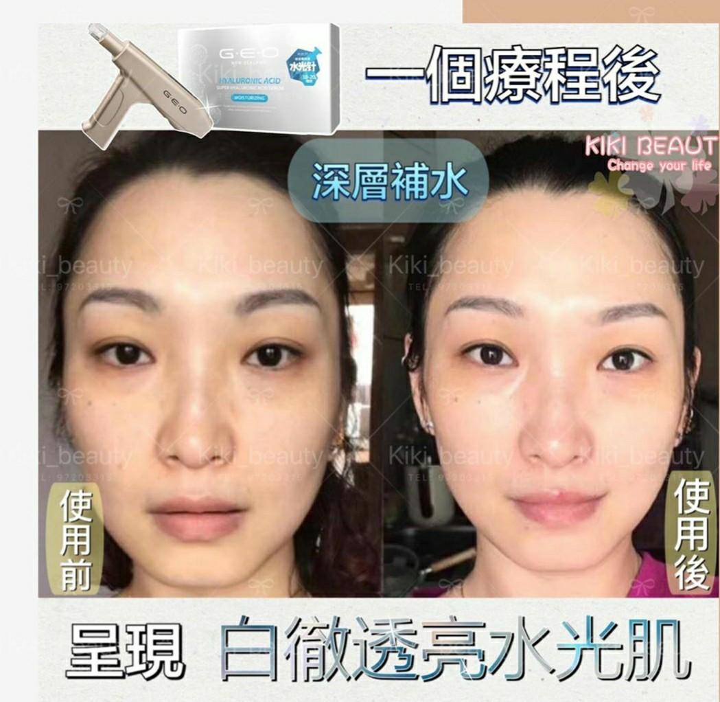 Hm Treament Before and after photo (Geoskincare), Beauty & Personal ...