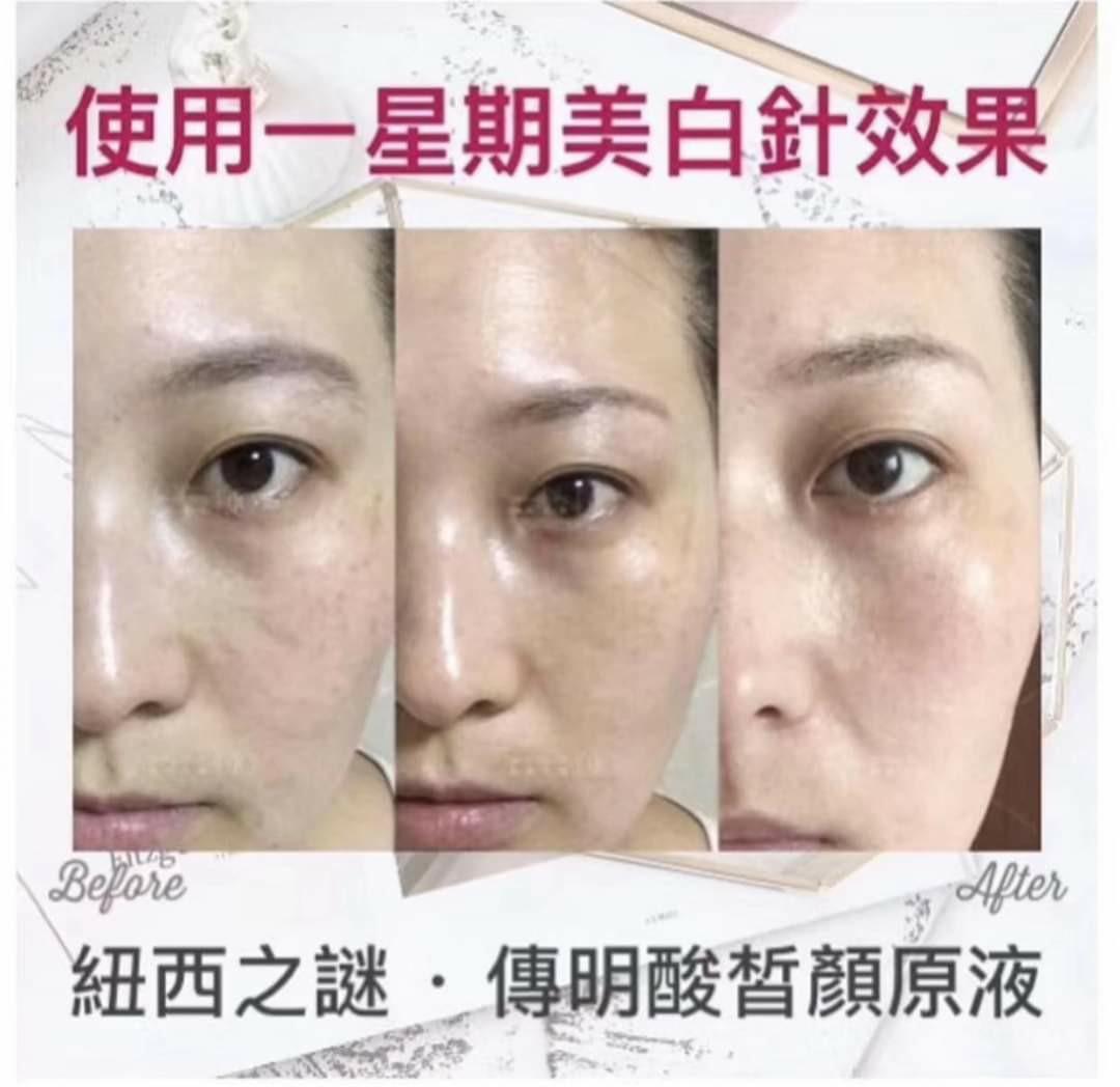 Hm Treament Before and after photo (Geoskincare), Beauty & Personal ...
