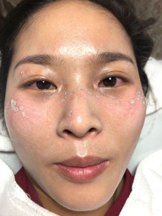 Facial treament and Skin management, Health & Beauty, Face & Skin Care ...
